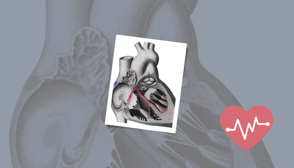 Rbbb Czyli Blok Prawej Odnogi Pęczka Hisa • Novmed